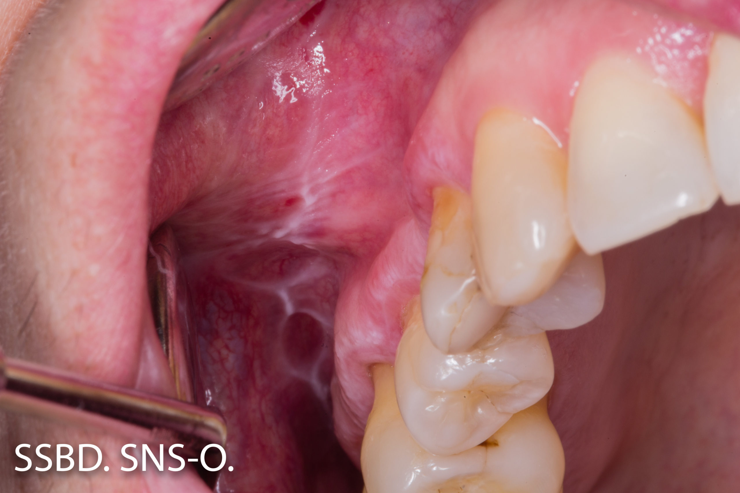 Liquen plano reticular | Odontologos de Hoy