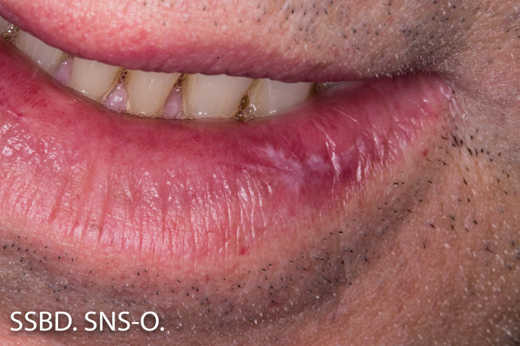 Liquen plano reticular | Odontologos de Hoy