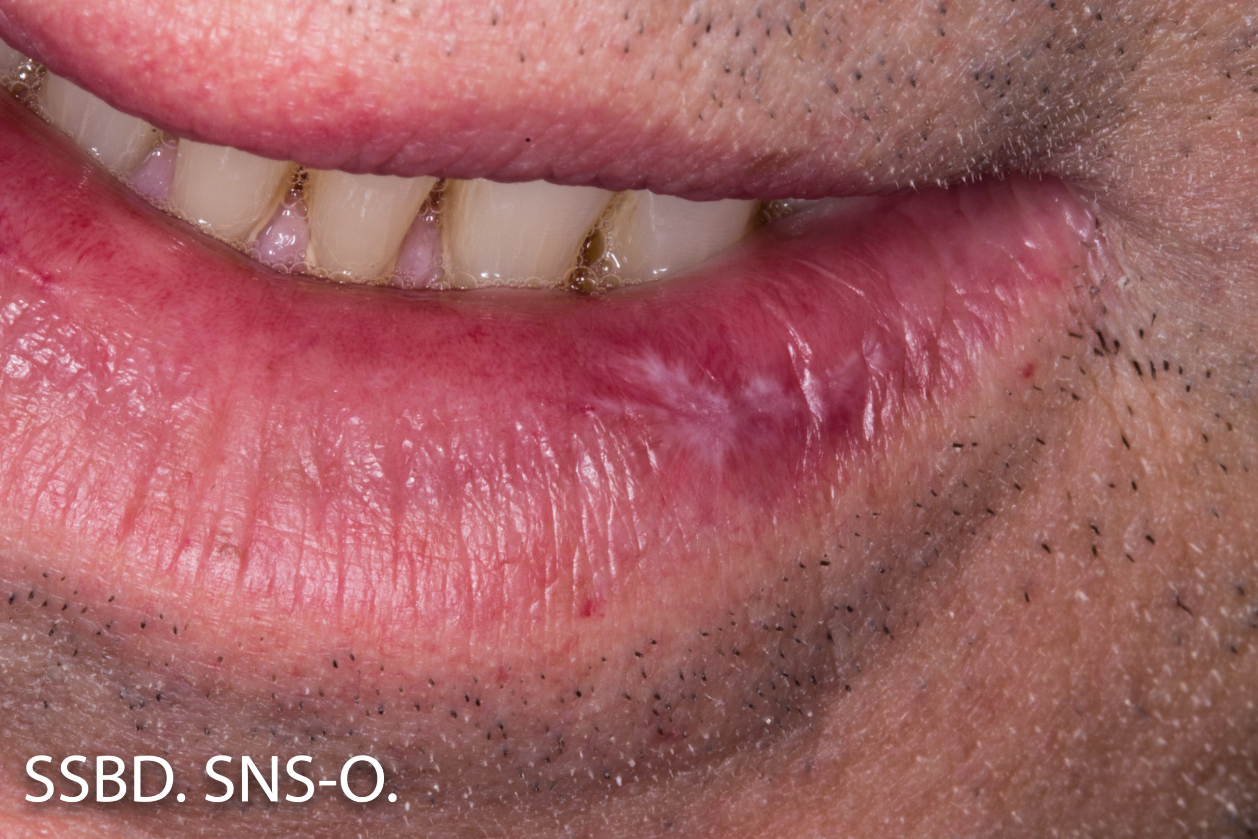 Liquen Plano Reticular