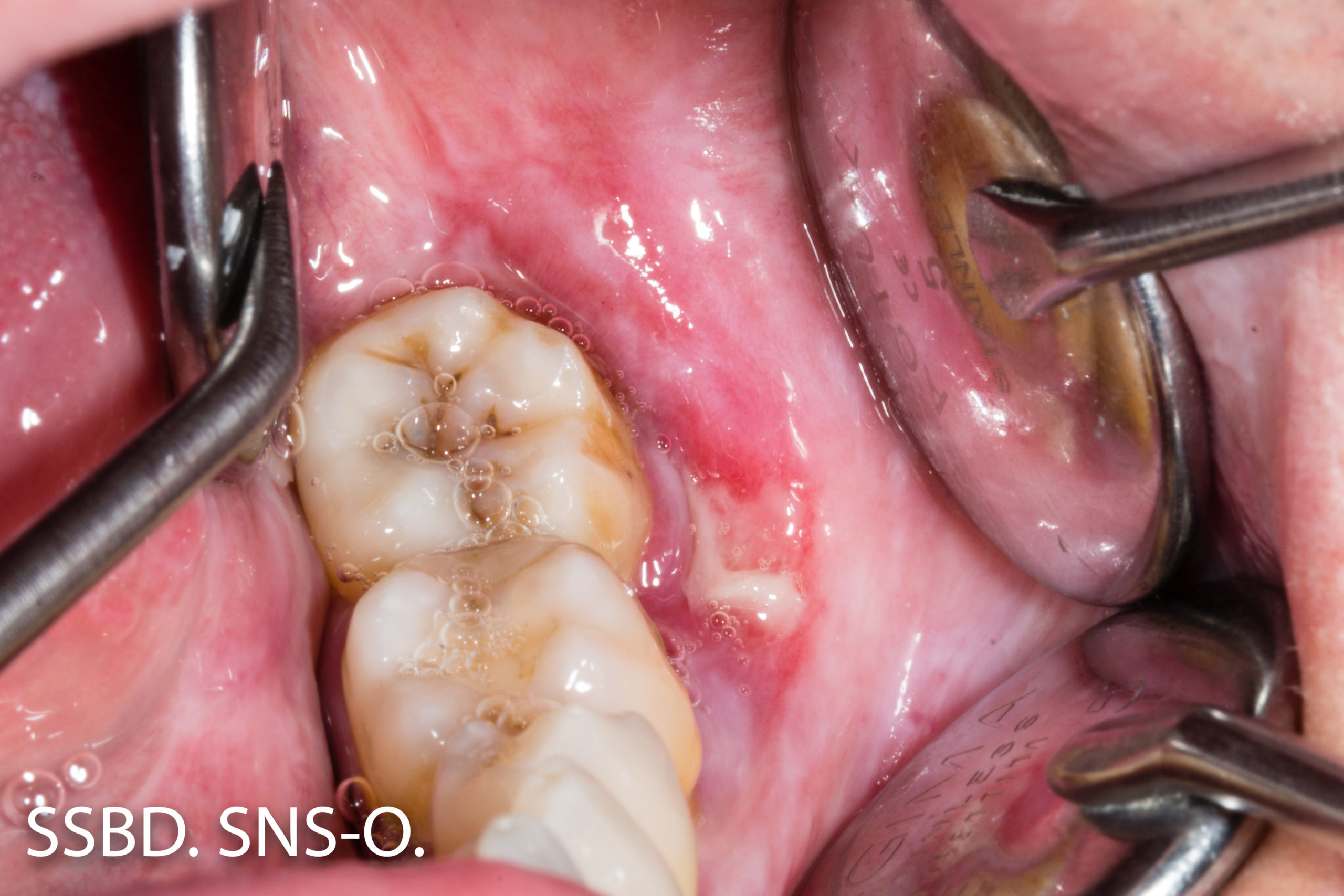 Liquen Plano Reticular