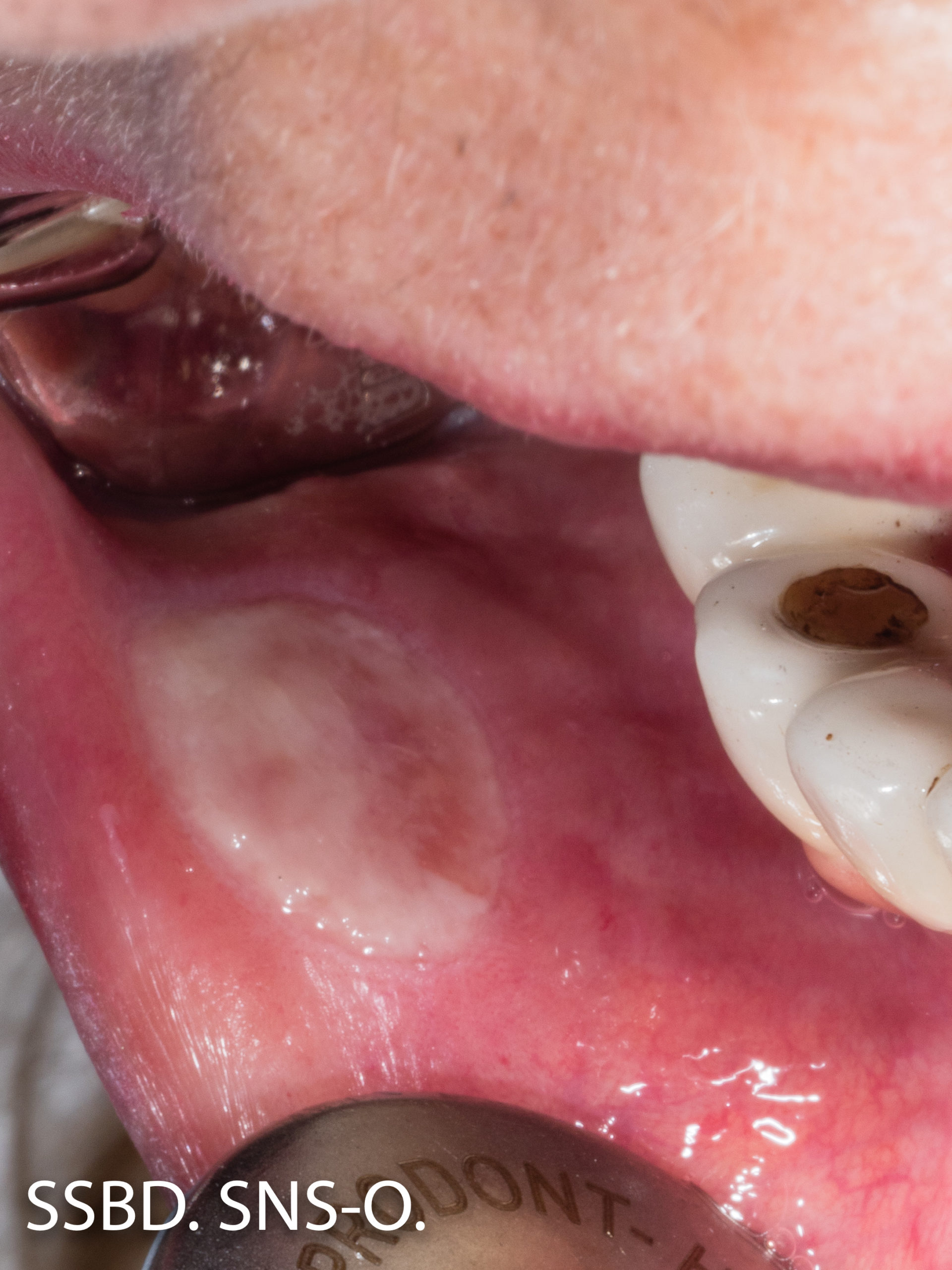 Chancro sifilítico | Odontologos de Hoy