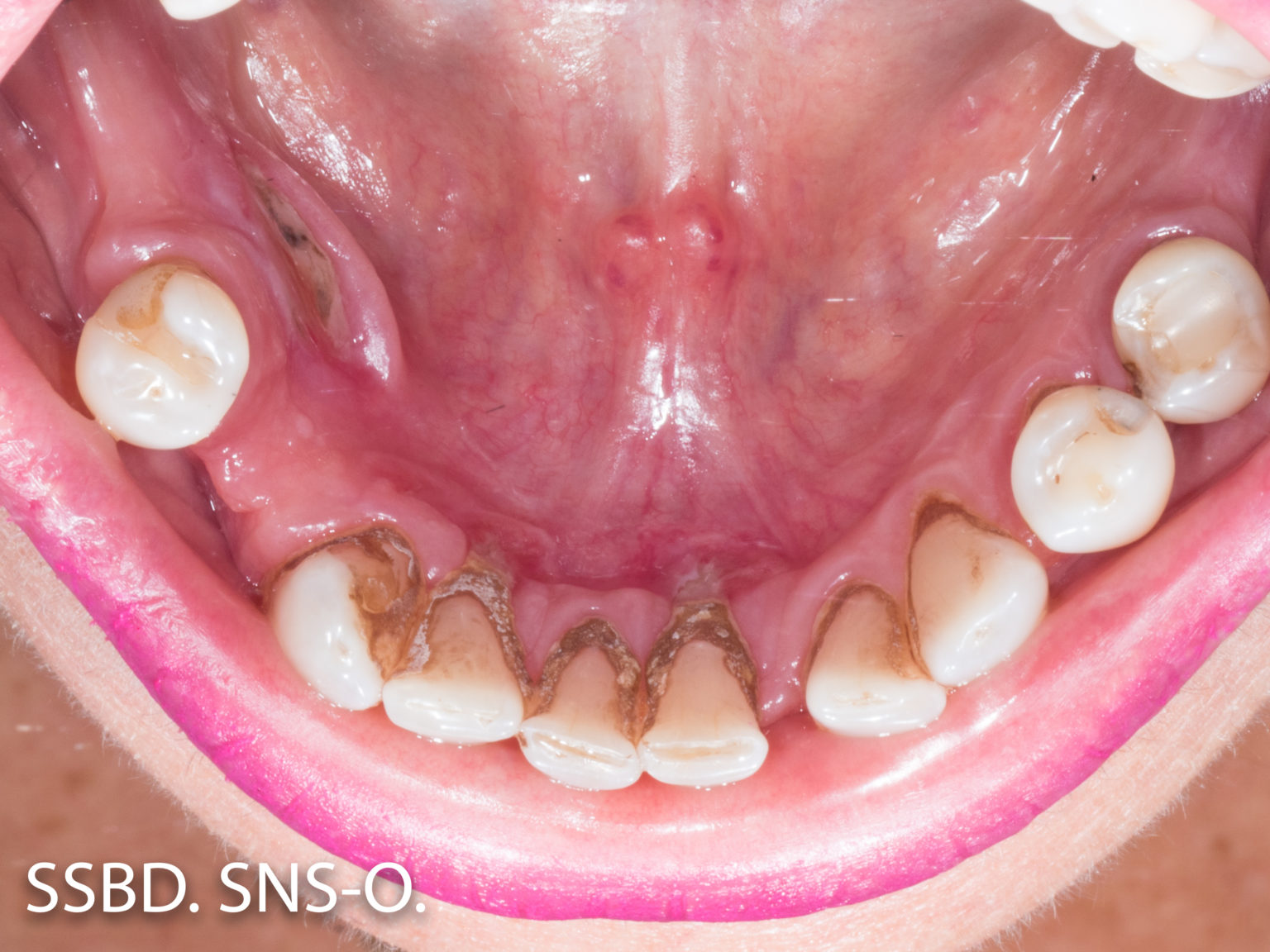 Casos clínicos Patología Oral | Odontologos de Hoy