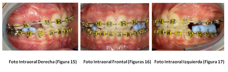 MANEJO DE LOS 3 PLANOS DEL ESPACIO EN ORTODONCIA | Odontologos de Hoy