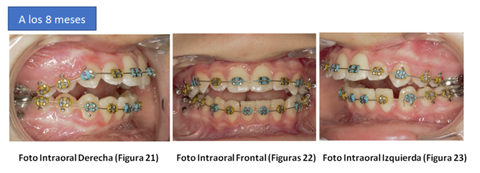 MANEJO DE LOS 3 PLANOS DEL ESPACIO EN ORTODONCIA | Odontologos de Hoy